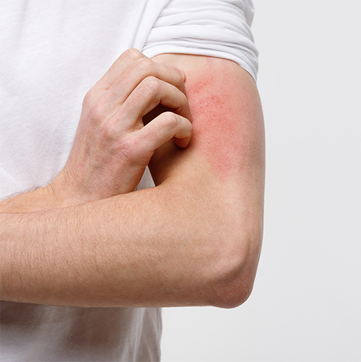 Perméthrine - Médicament indiqué dans le traitement de la gale | Marché ...